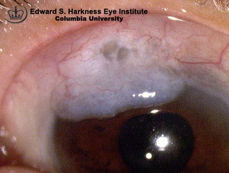 Overhanging Bleb | Vagelos College of Physicians and Surgeons