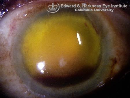 Corneal Blood Staining | Vagelos College of Physicians and Surgeons