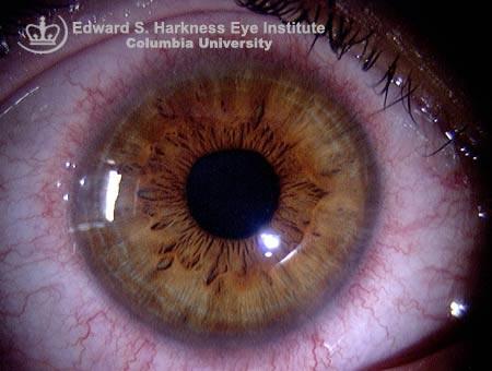 Corneal Neovascularization | Vagelos College of Physicians and Surgeons