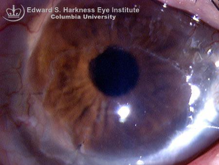 Epithelial Rejection Line | Vagelos College of Physicians and Surgeons