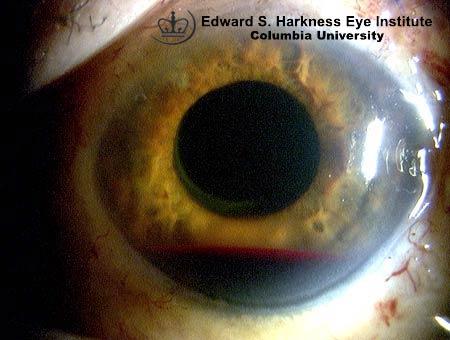 Hyphema | Vagelos College of Physicians and Surgeons