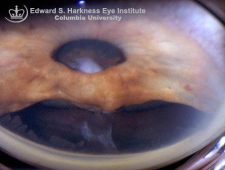 Iridodialysis | Vagelos College of Physicians and Surgeons