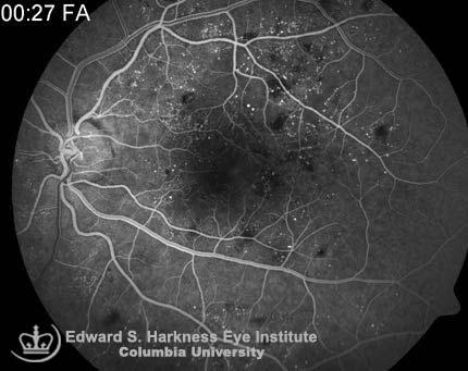 Nonproliferative Diabetic Retinopathy (NPDR) | Vagelos College of ...