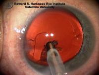 Cortical Aspiration | Vagelos College of Physicians and Surgeons