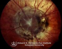 Morning Glory Anomaly | Vagelos College of Physicians and Surgeons