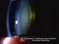 Posterior Subcapsular | Vagelos College of Physicians and Surgeons