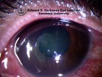 Recurrent Corneal Erosion | Vagelos College of Physicians and Surgeons