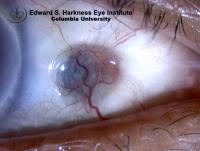 Scleral Thinning | Vagelos College of Physicians and Surgeons