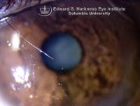 Trichiasis | Vagelos College of Physicians and Surgeons