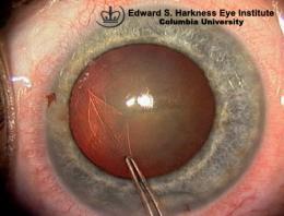 Capsulorrhexis | Vagelos College of Physicians and Surgeons