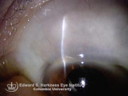 Inadvertent Filtering Bleb | Vagelos College of Physicians and Surgeons