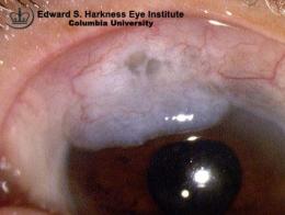 Overhanging Bleb | Vagelos College of Physicians and Surgeons