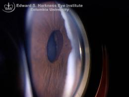 Peripheral Anterior Synechiae | Vagelos College of Physicians and Surgeons