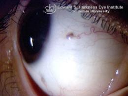 Axenfeld Nerve Loop | Vagelos College of Physicians and Surgeons