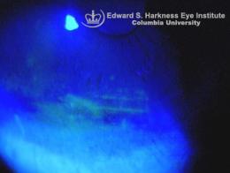 Exposure Keratitis | Vagelos College of Physicians and Surgeons