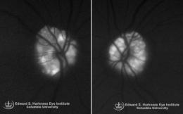 Optic Nerve Drusen | Vagelos College of Physicians and Surgeons