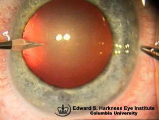 Paracentesis | Vagelos College of Physicians and Surgeons