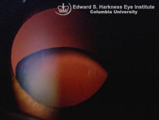 Subluxated Lens | Vagelos College of Physicians and Surgeons