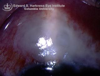 Blebitis | Vagelos College of Physicians and Surgeons