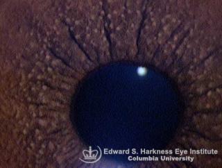 Iris Mamillations | Vagelos College of Physicians and Surgeons