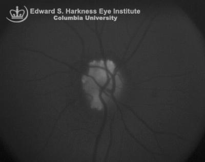 Autofluorescence of Optic Nerve Drusen | Vagelos College of Physicians ...