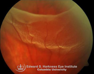 Retinal Detachment | Vagelos College of Physicians and Surgeons