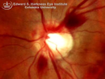 Splinter Optic Disc Hemorrhage | Vagelos College of Physicians and Surgeons