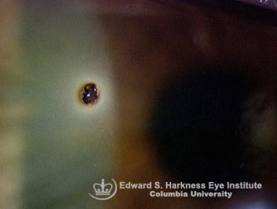 Corneal Foreign Body | Vagelos College of Physicians and Surgeons