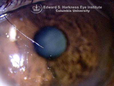 Trichiasis | Vagelos College of Physicians and Surgeons
