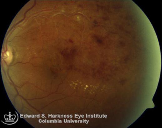 Chronic BRVO | Vagelos College of Physicians and Surgeons