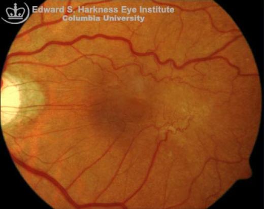 Epiretinal Membrane | Vagelos College of Physicians and Surgeons