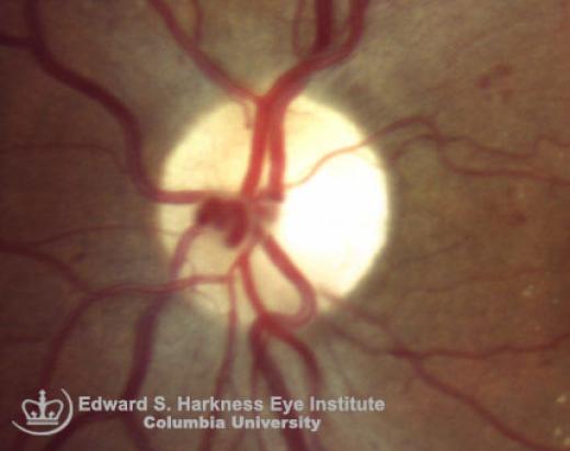 Prepapillary Vascular Loops | Vagelos College of Physicians and Surgeons