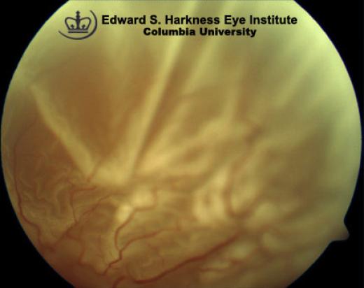 Proliferative Vitreoretinopathy | Vagelos College of Physicians and ...