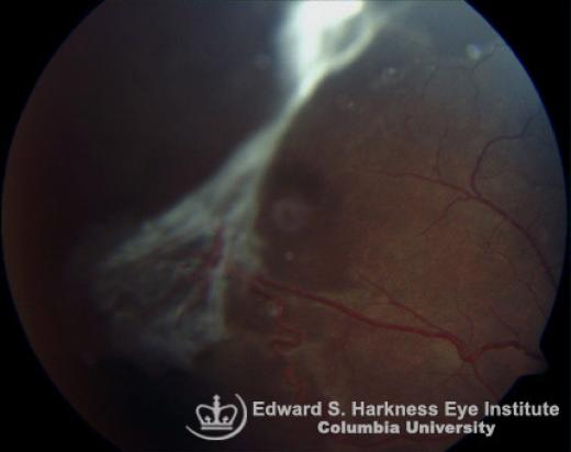 Sickle Cell Proliferative Retinopathy | Vagelos College of Physicians ...