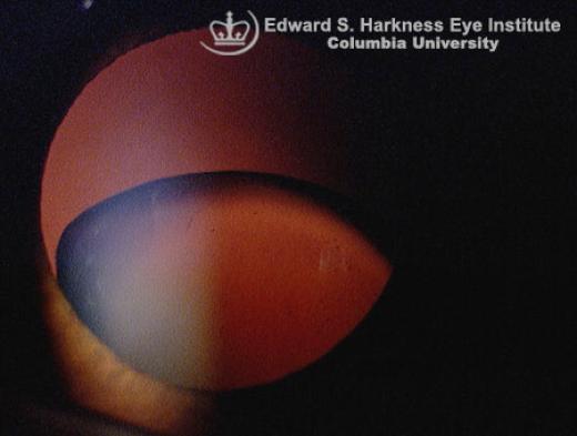 Subluxated Lens | Vagelos College of Physicians and Surgeons