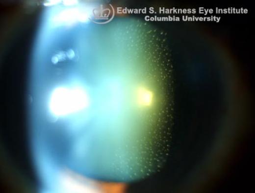 White Dot Cataract | Vagelos College of Physicians and Surgeons