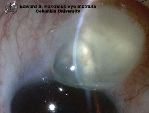 Encapsulated Bleb | Vagelos College of Physicians and Surgeons