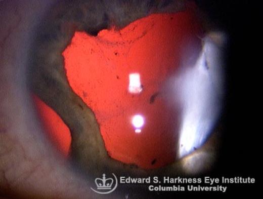 Traumatic Iridodialysis | Vagelos College of Physicians and Surgeons