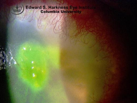 Bacterial Corneal Ulcer | Vagelos College of Physicians and Surgeons