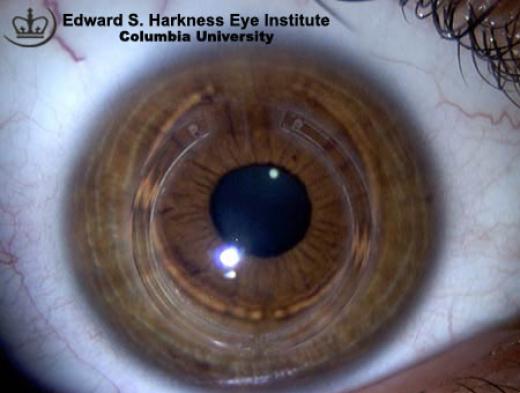 Intrastromal Corneal Ring | Vagelos College of Physicians and Surgeons