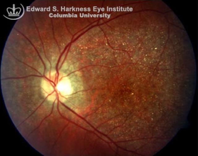 Bietti's Crystalline Retinopathy | Vagelos College of Physicians and ...