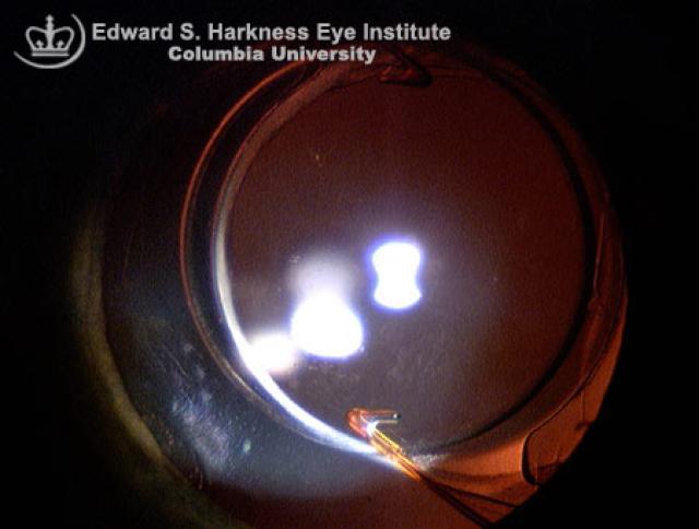 Piggy Back IOLs | Vagelos College of Physicians and Surgeons