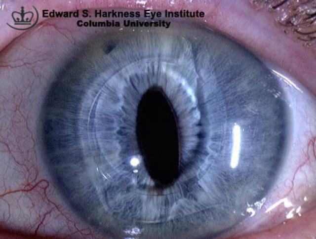 Pupil Ovalization | Vagelos College of Physicians and Surgeons