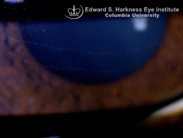 Haab's Striae | Vagelos College of Physicians and Surgeons