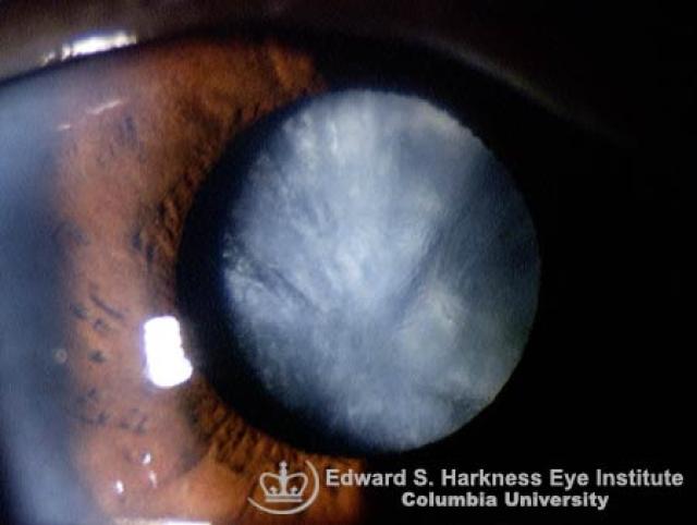 Phacolytic Glaucoma | Vagelos College of Physicians and Surgeons