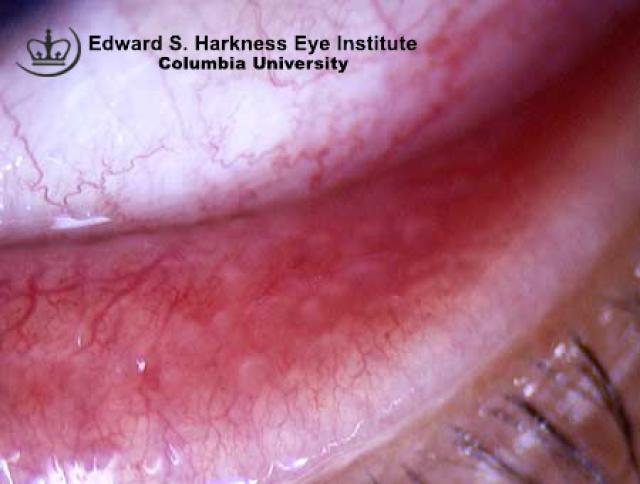 Allergic Conjunctivitis | Vagelos College of Physicians and Surgeons