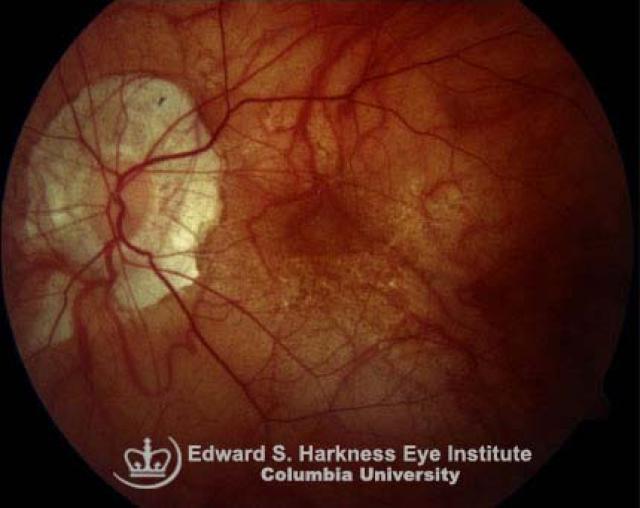Degenerative Myopia | Vagelos College of Physicians and Surgeons