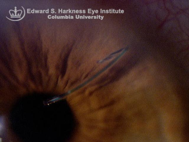Haptic of PC IOL Penetrating the Iris | Vagelos College of Physicians ...