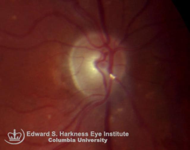 Hollenhorst Plaque | Vagelos College of Physicians and Surgeons