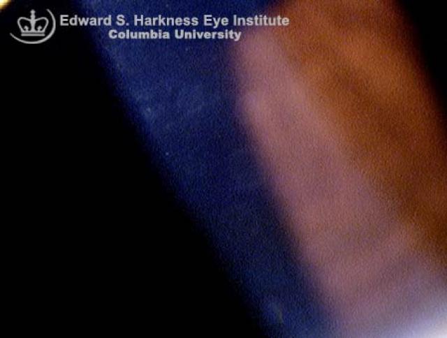 Posterior Polymorphous Dystrophy | Vagelos College of Physicians and ...